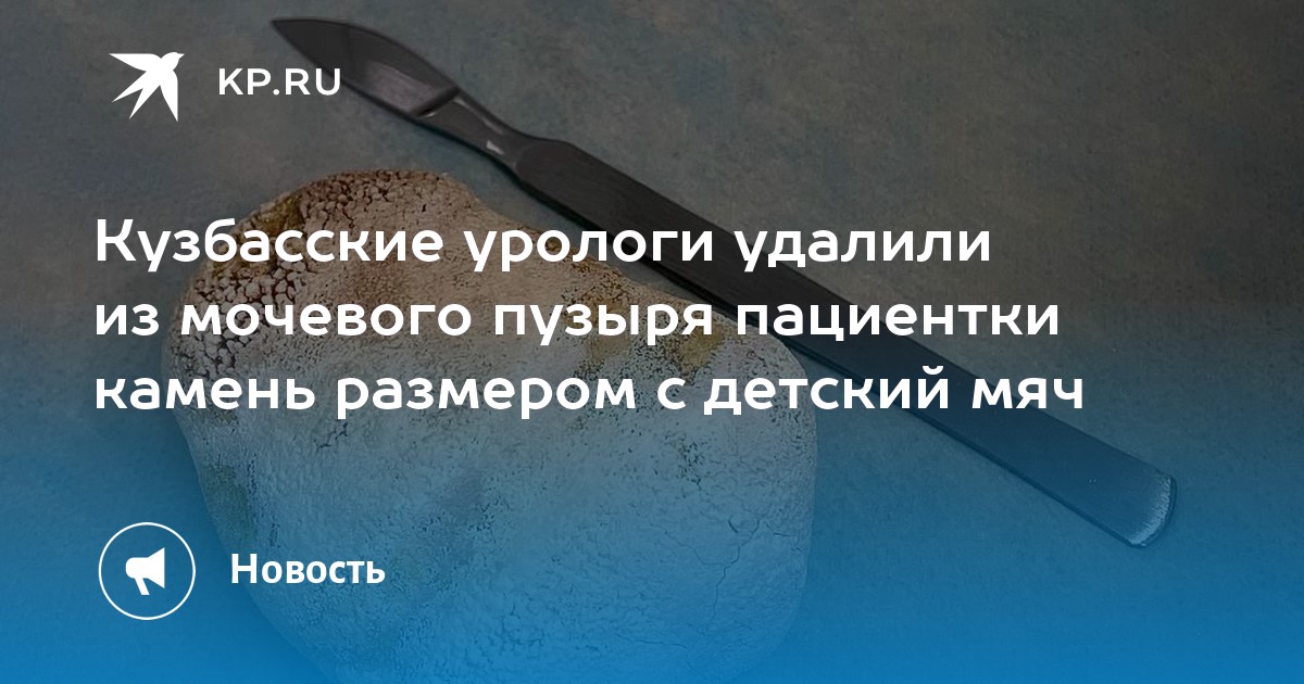 Кузбасские урологи удалили из мочевого пузыря пациентки камень размером с детский мяч Kp Ru